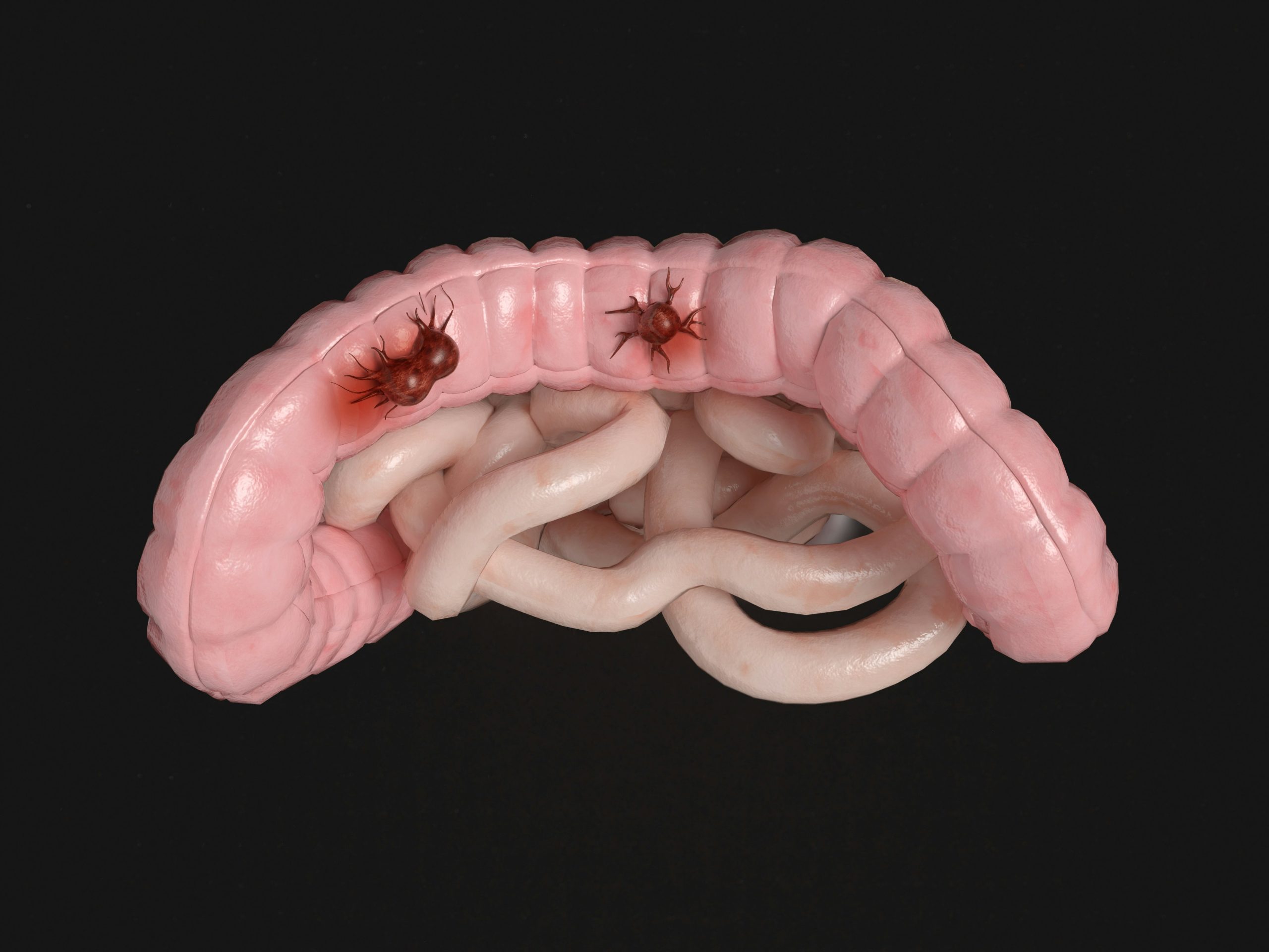 Colon Polyps and Endoscopic Resection: Minimizing Risk Through Precise ...